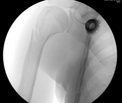 Shoulder Fracture | Colorado Shoulder Specialist | Vail CO