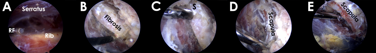 Snapping Scapula | Scapulothoracic Bursitis | Colorado