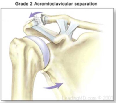 AC Shoulder Separation | Acromioclavicular AC Joint Pain | Vail, Denver ...