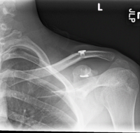 Shoulder Dislocation | Shoulder Separation | Vail, Aspen, Denver CO