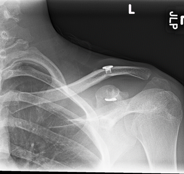Shoulder Dislocation | Shoulder Separation | Vail, Aspen, Denver CO