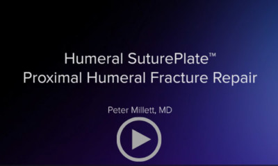Proximal Humerus Fracture: Open Reduction Internal Fixation With ...